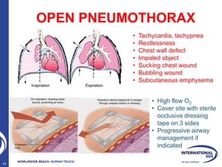 Chest Trauma (pedoman trauma tugas belajar) | PPT