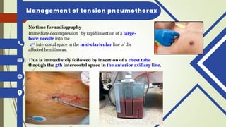 CHEST TRAUMA and Thoracic outlet syndrome- AMRAN UN.pptx