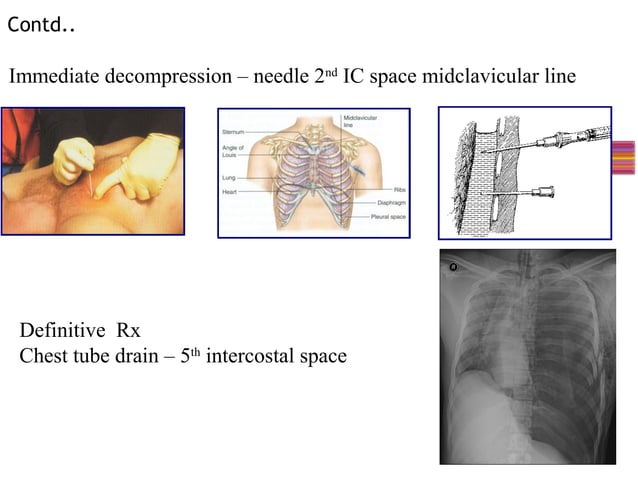 Chest trauma | PPT