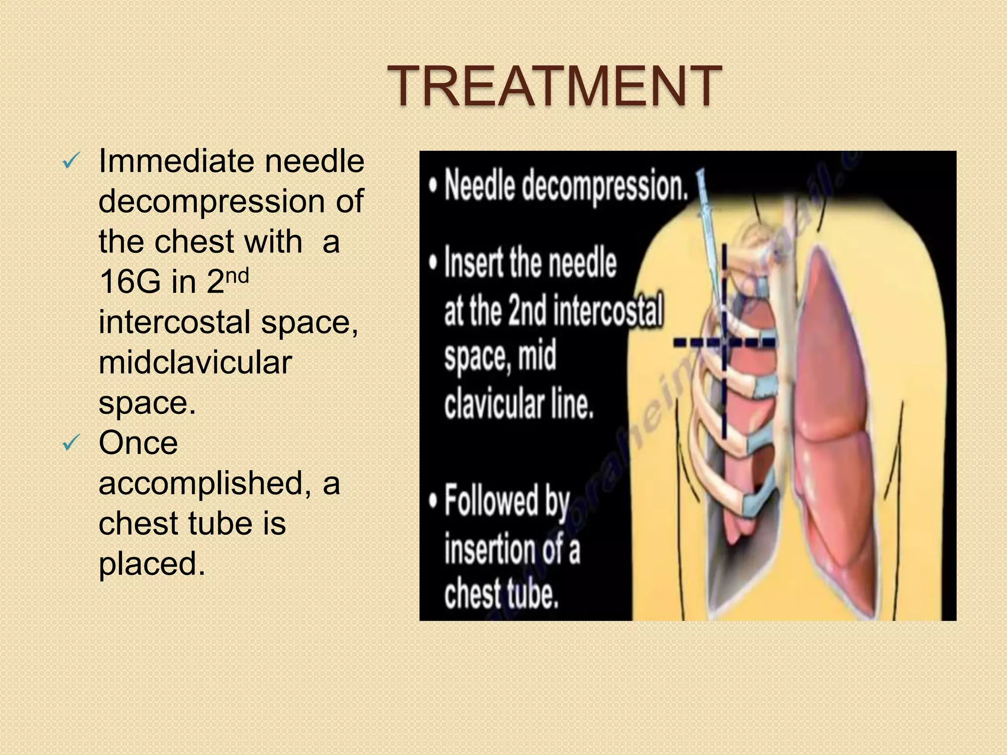 Chest trauma | PPTX