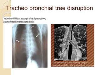Chest trauma | PPTX