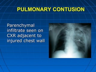 Chest trauma | PPT