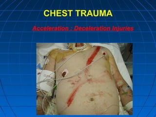 Chest trauma | PPT