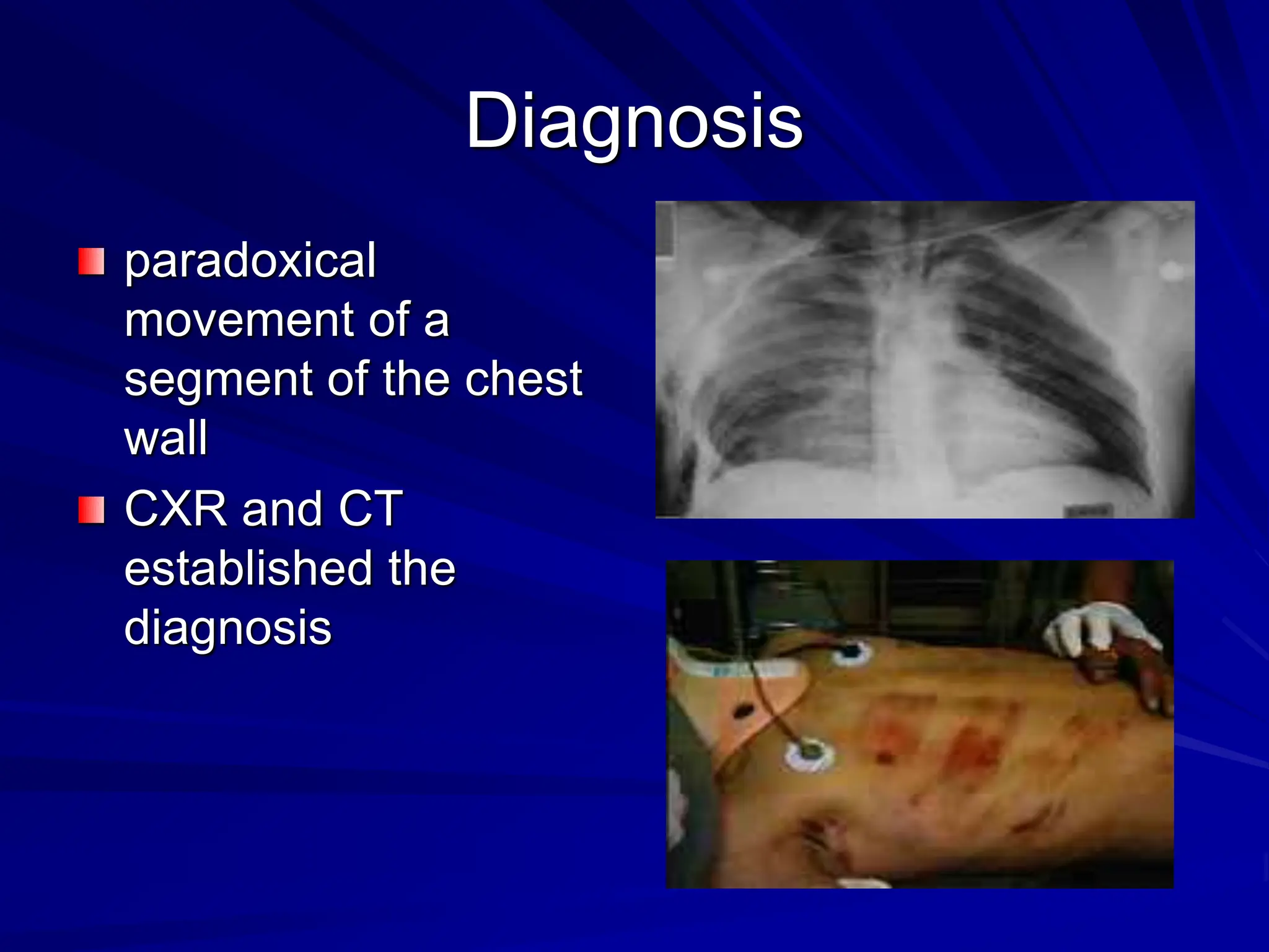 Chest trauma and indication for thoracotomy.ppt