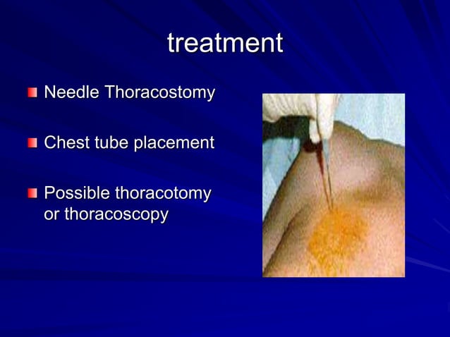 Chest trauma and indication for thoracotomy.ppt | Death, Injury, or Military Conflict ...