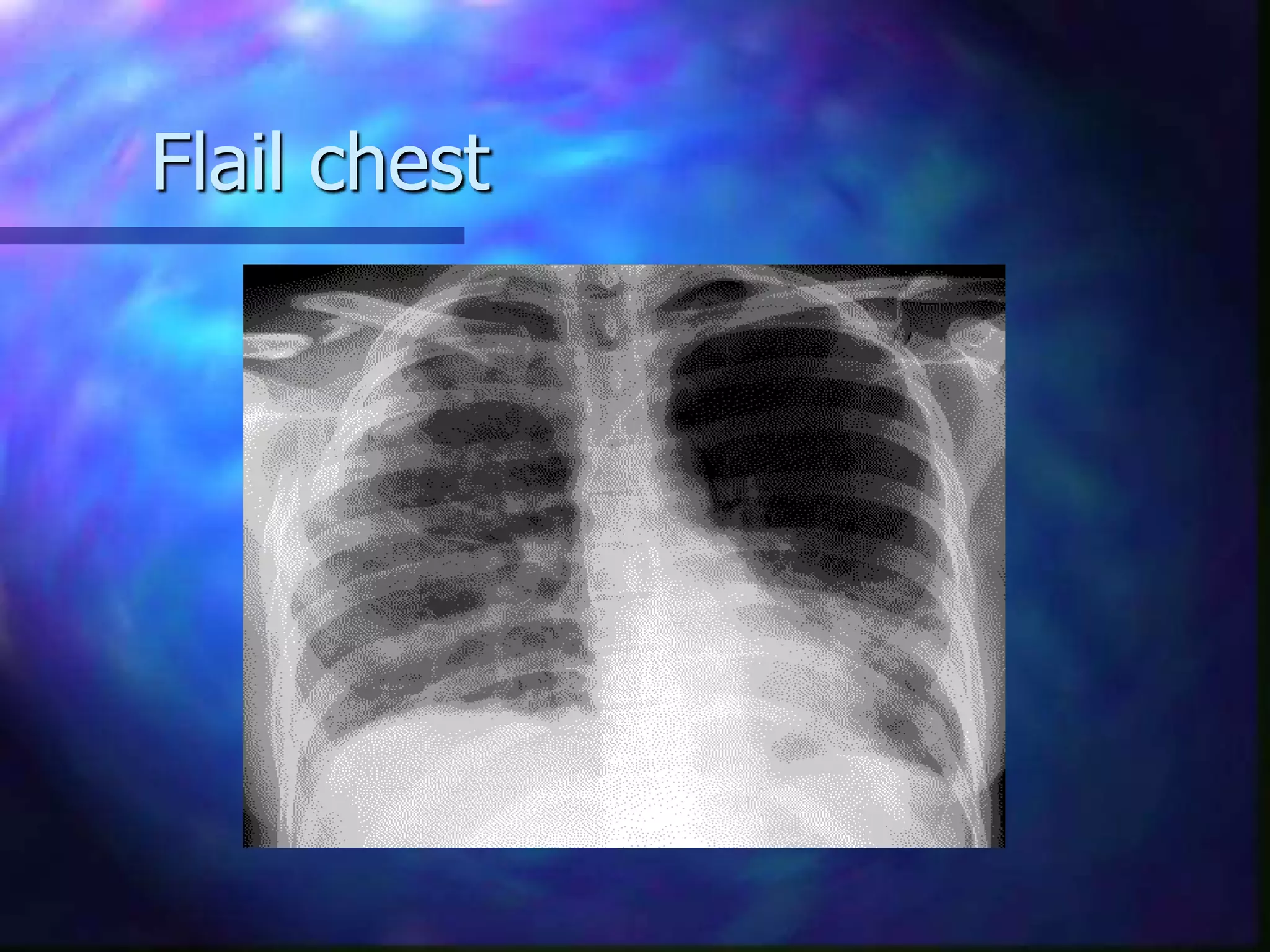 chest_trauma ATLS..ppt