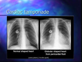 chest_trauma ATLS..ppt
