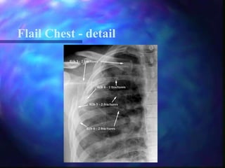 chest_trauma ATLS..ppt