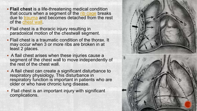 Chest Trauma .pptx