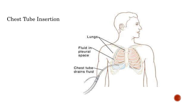Chest Trauma .pptx