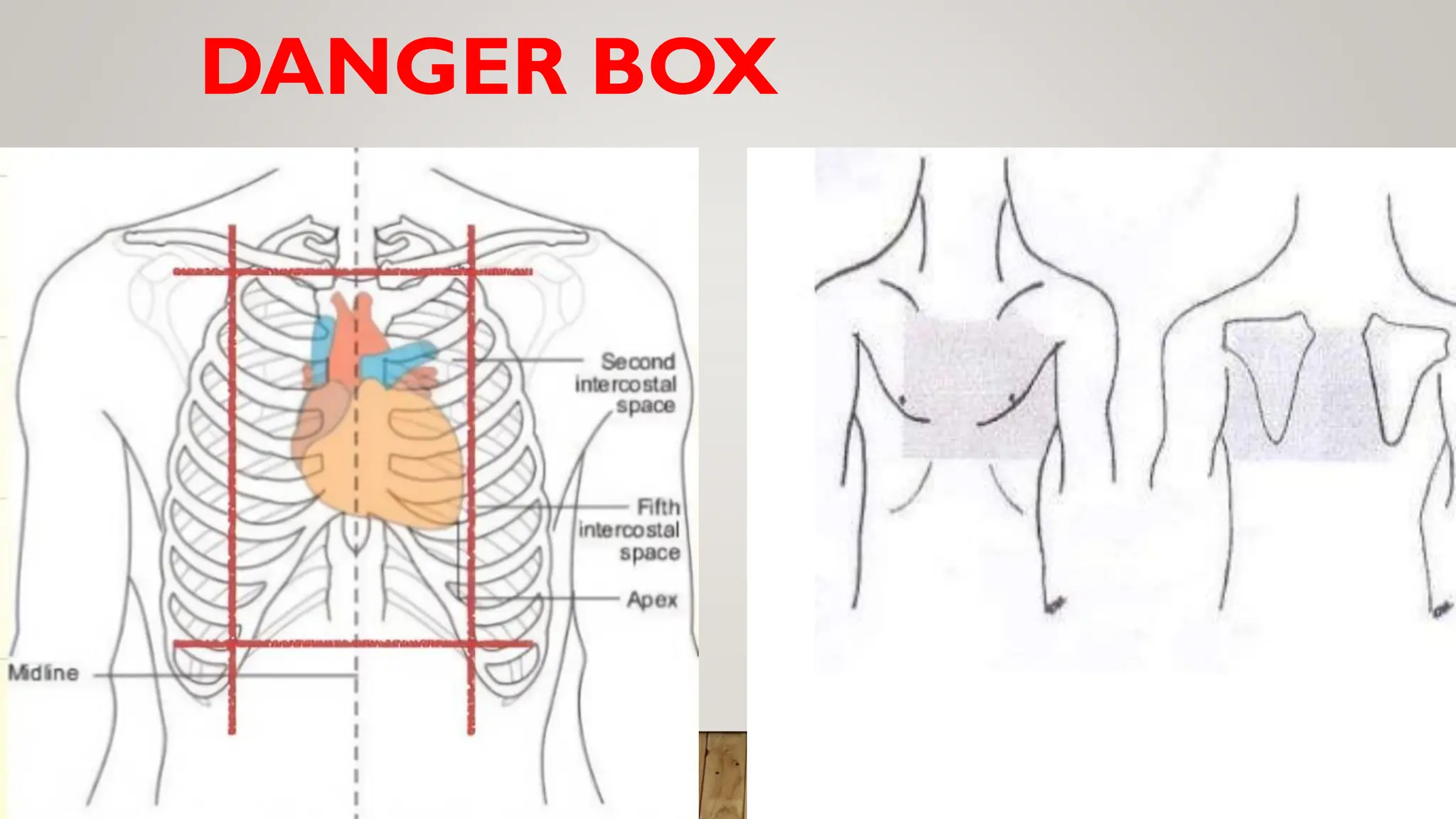 Chest Trauma MBBS teaching in Lilongwe Malawi | PPT