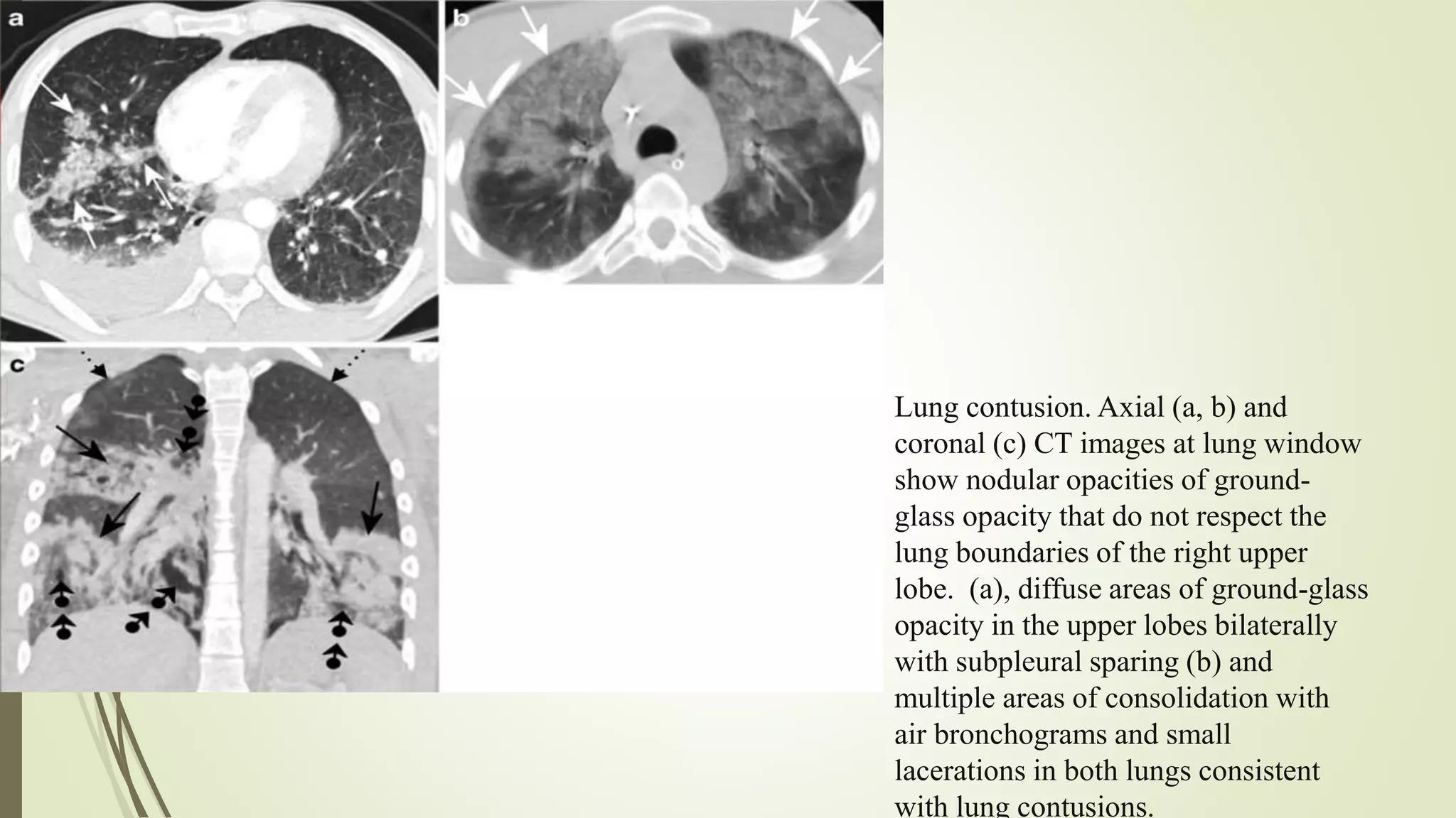 chest trauma ppt 3.0.pptx