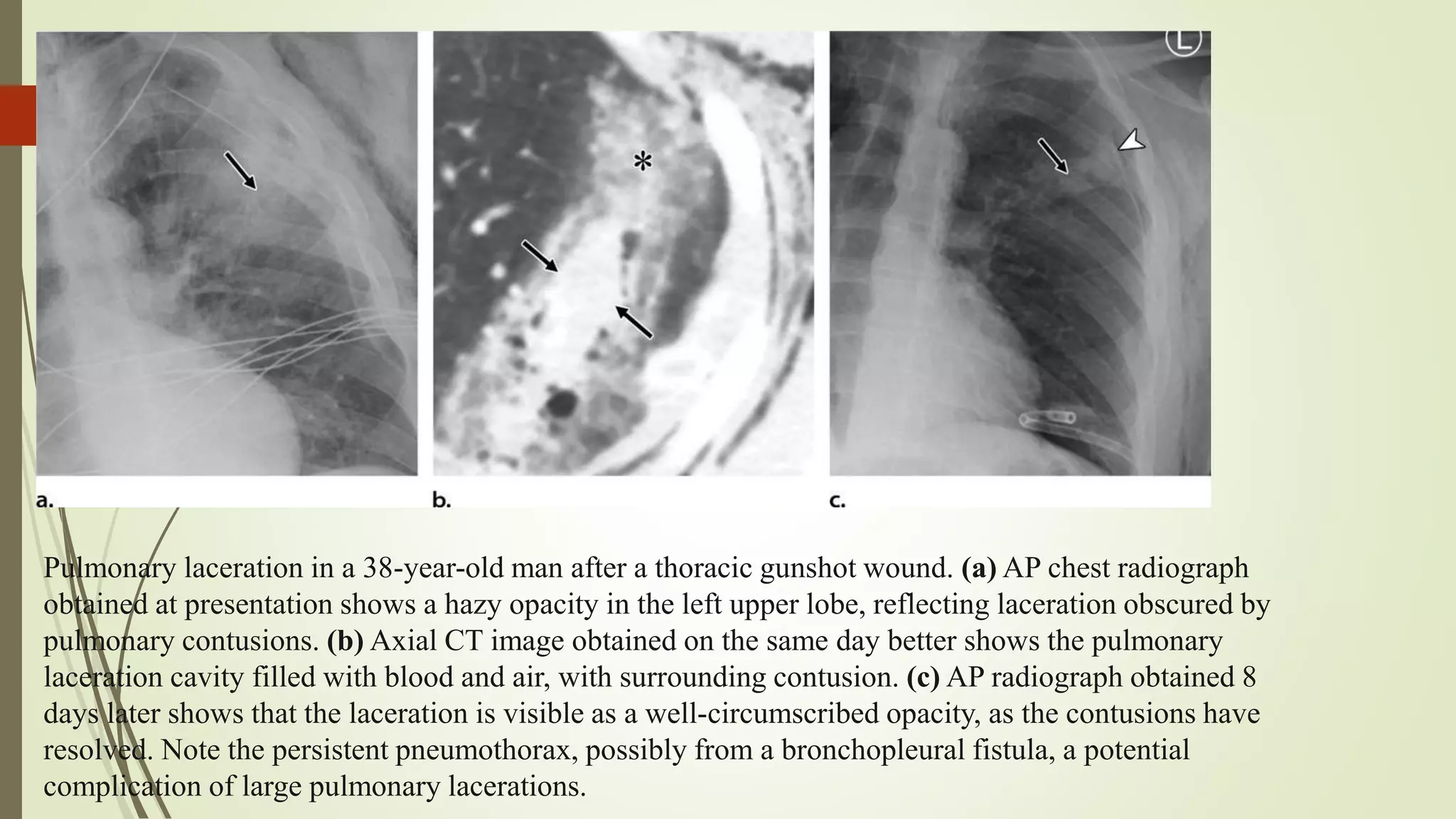 chest trauma ppt 3.0.pptx