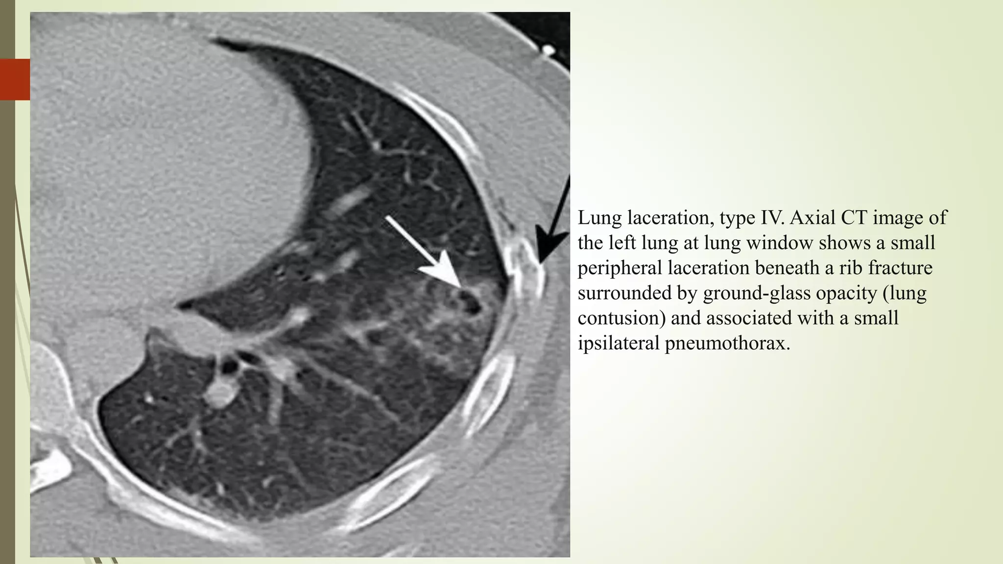 chest trauma ppt 3.0.pptx