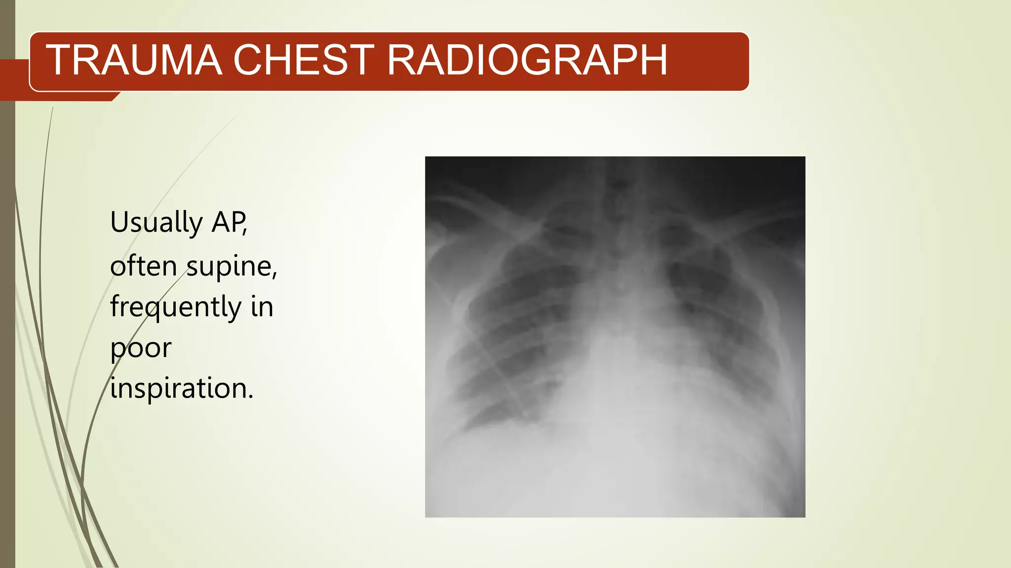 chest trauma ppt 3.0.pptx
