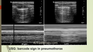 chest trauma ppt 3.0.pptx