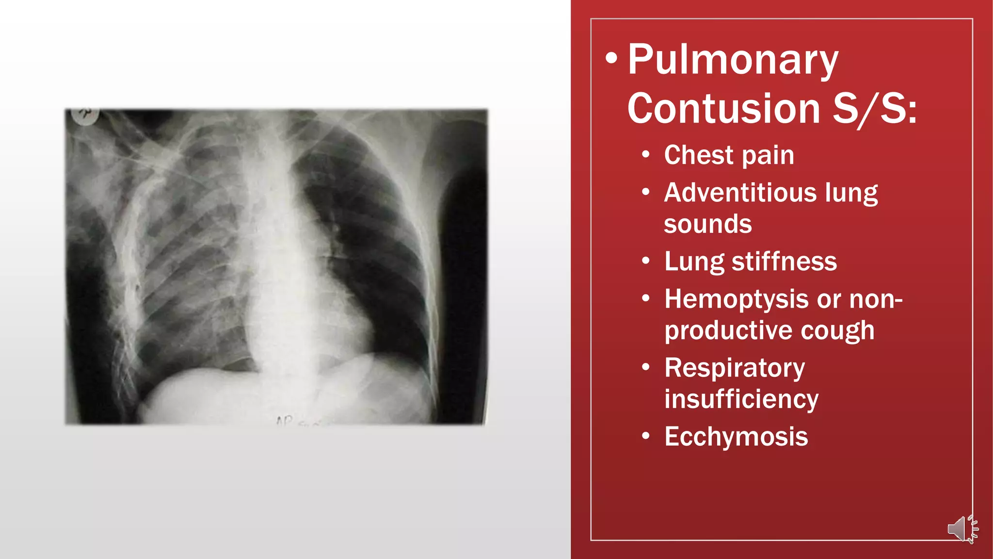 Chest trauma ppt for lems | PPTX