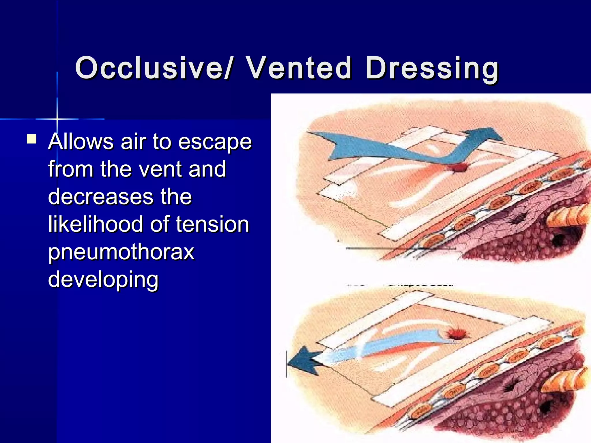 Chest trauma presentation | PPT