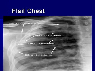 Chest trauma presentation | PPT