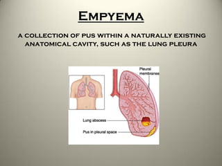 Chest tube care copy | PDF