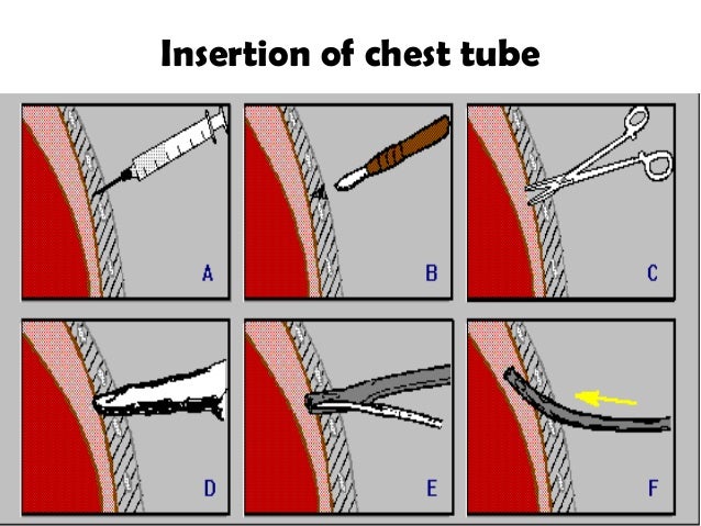 Chest tube cross