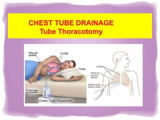 chest tube drainage2 uses and indecation | PPTX