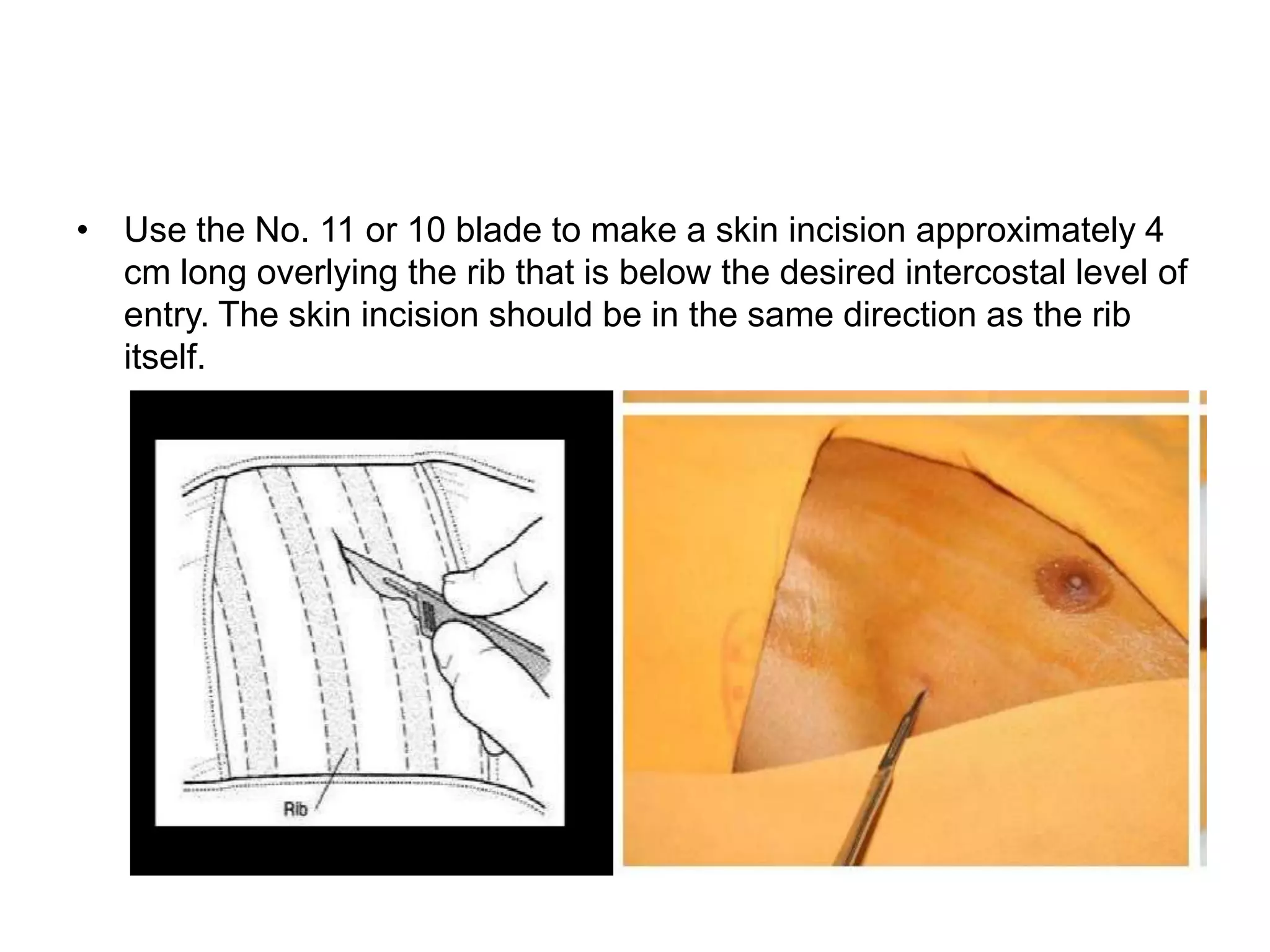 Chest tube insertion | PPTX