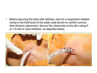 Chest tube insertion | PPT