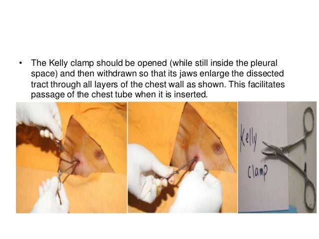 Chest tube insertion