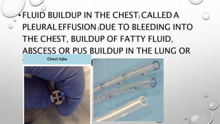 Chest tube insertion care important to me | PPTX