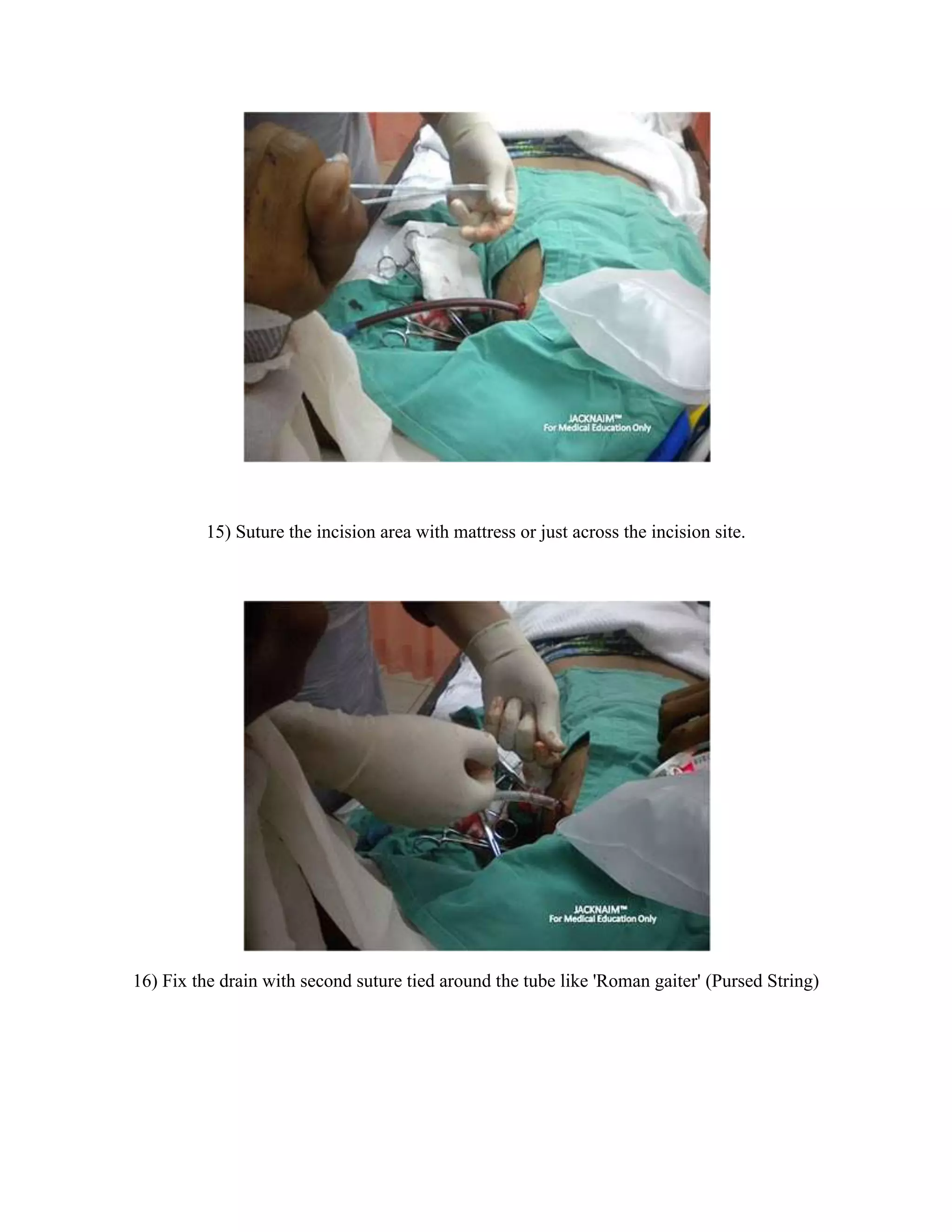 Chest Tube Insertion Made Easy | DOCX