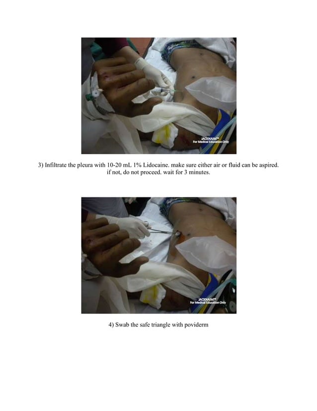 Chest Tube Insertion Made Easy | PDF