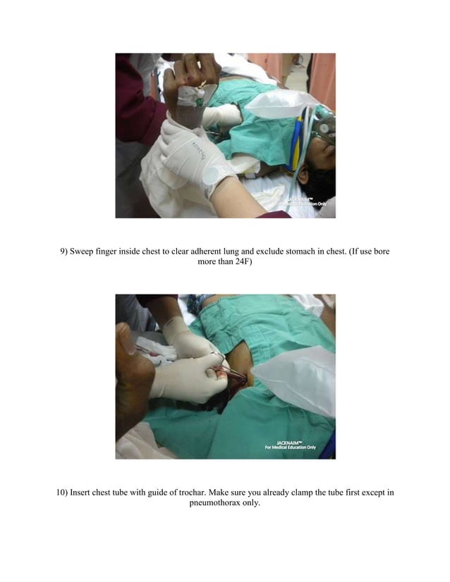 Chest Tube Insertion Made Easy | PDF