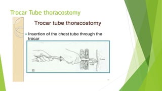 Intercostal Drainage Tubes -Indications,methods,uses | PPTX