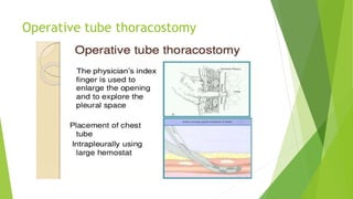 Intercostal Drainage Tubes -Indications,methods,uses | PPTX