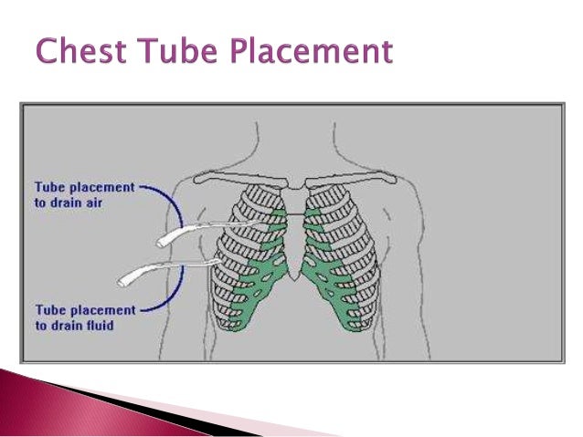 Chest tubes dmw