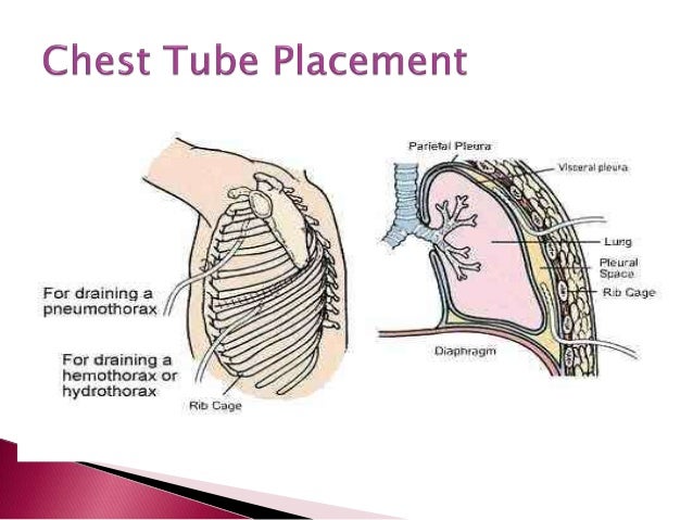 Chest tubes dmw