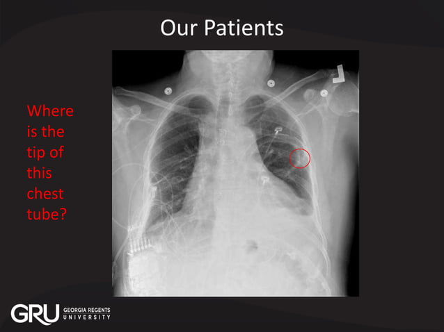 Chest tubes - what one needs to know? | PPT