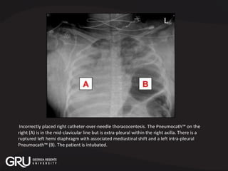 Chest tubes - what one needs to know? | PPTX