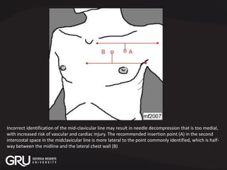 Chest tubes - what one needs to know? | PPTX