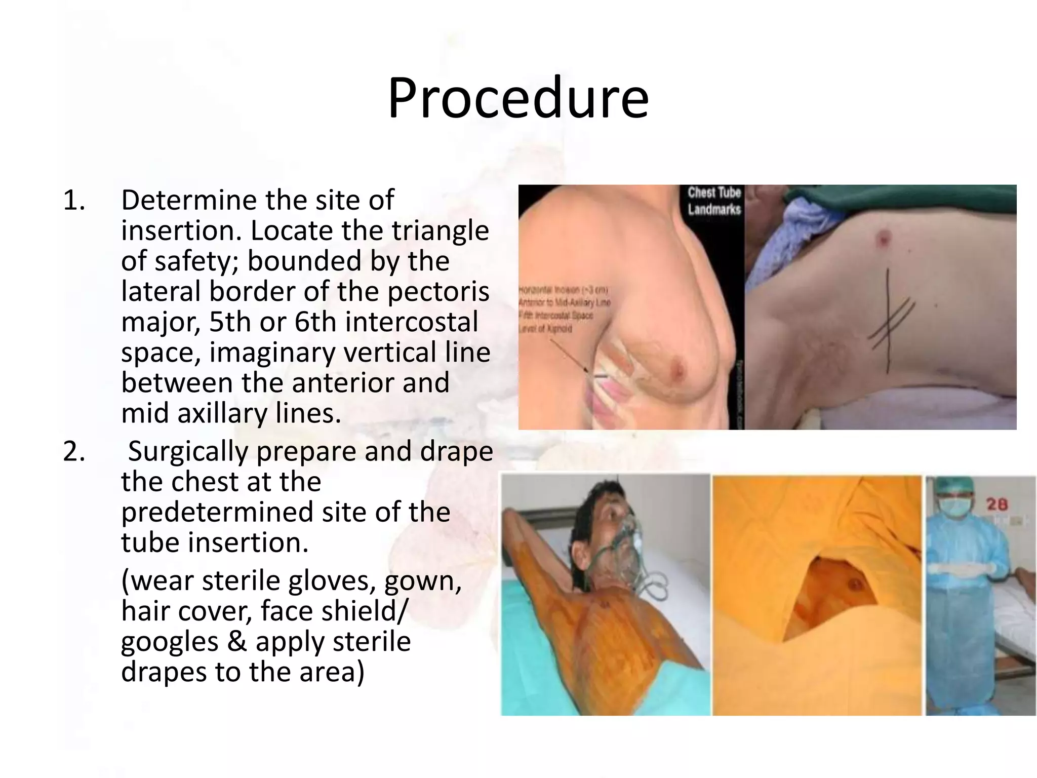 Chest tube insertion ppt (surgery) | PPTX