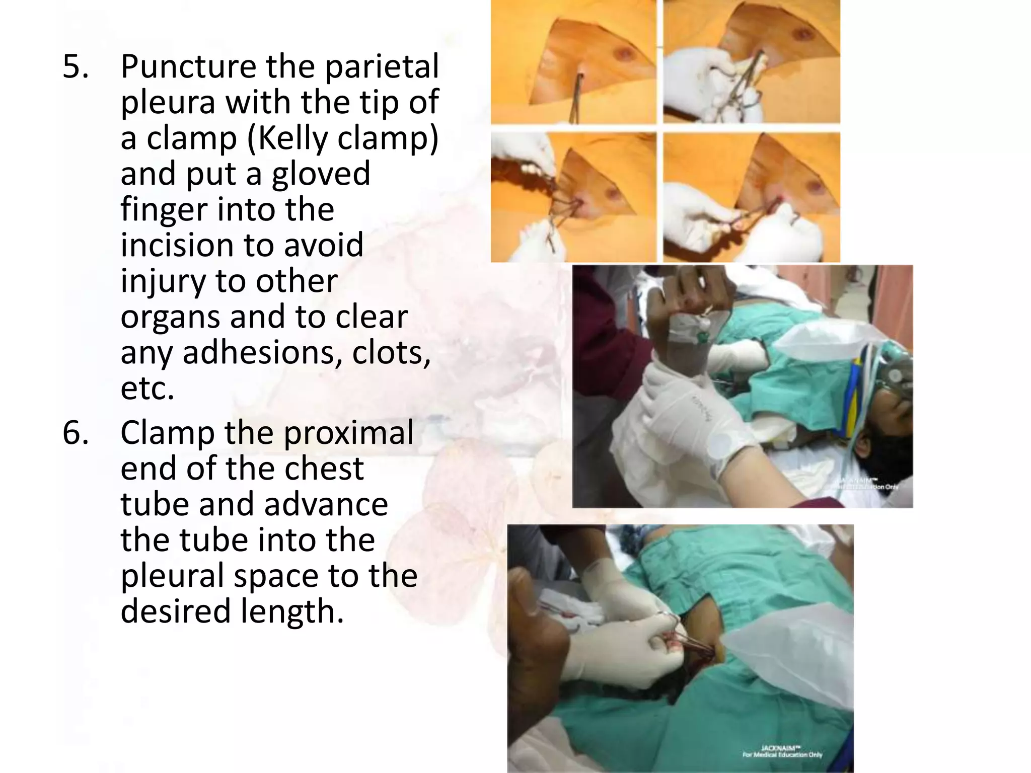 Chest tube insertion ppt (surgery) | PPTX