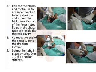 Chest tube insertion ppt (surgery) | PPTX