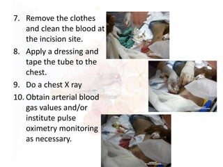 Chest tube insertion ppt (surgery) | PPTX