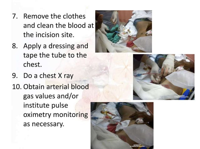 Chest tube insertion ppt (surgery) | PPTX