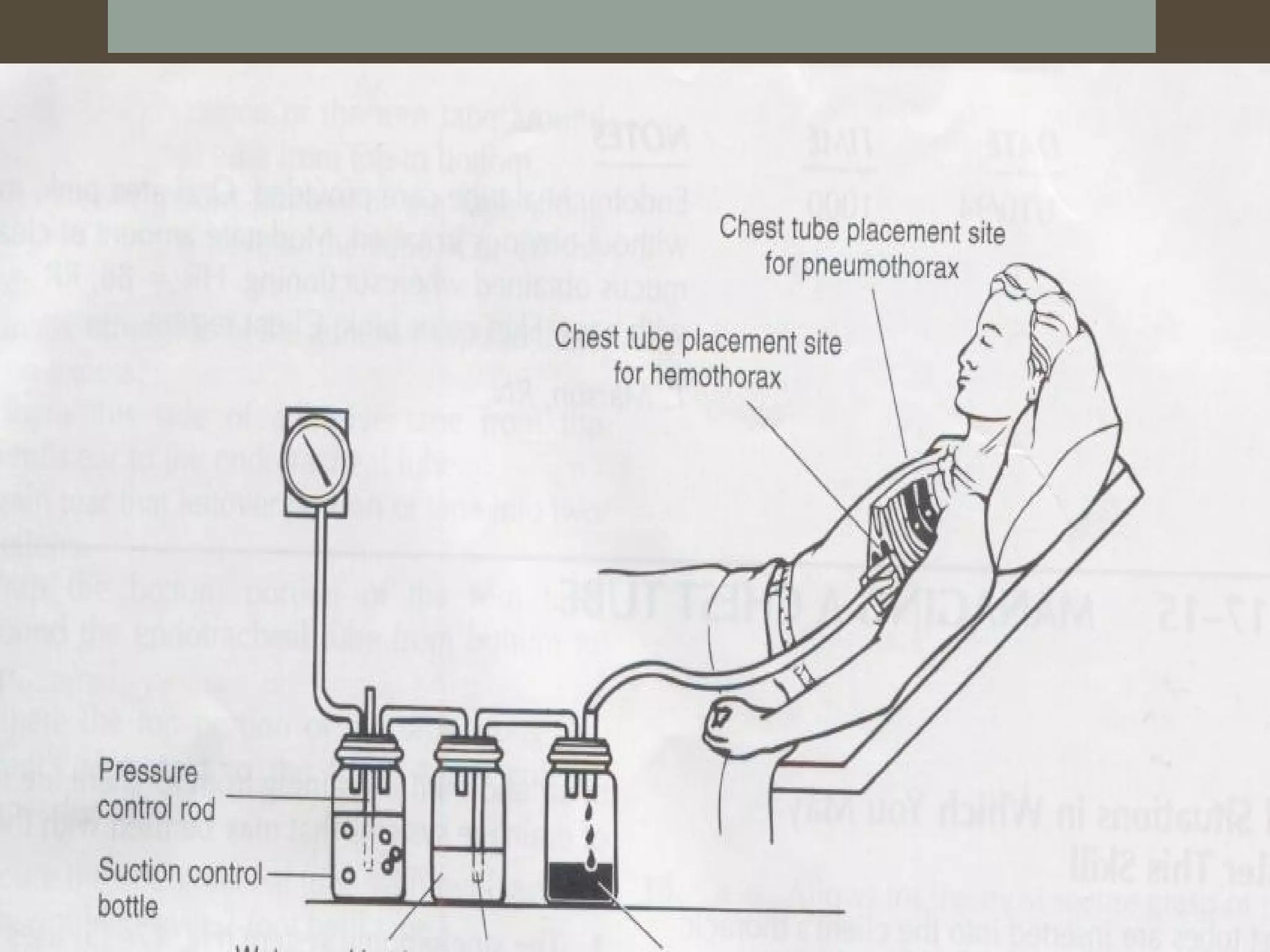 CHEST TUBE & UNDER WATER SEAL | PPT