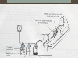 CHEST TUBE & UNDER WATER SEAL | PPT