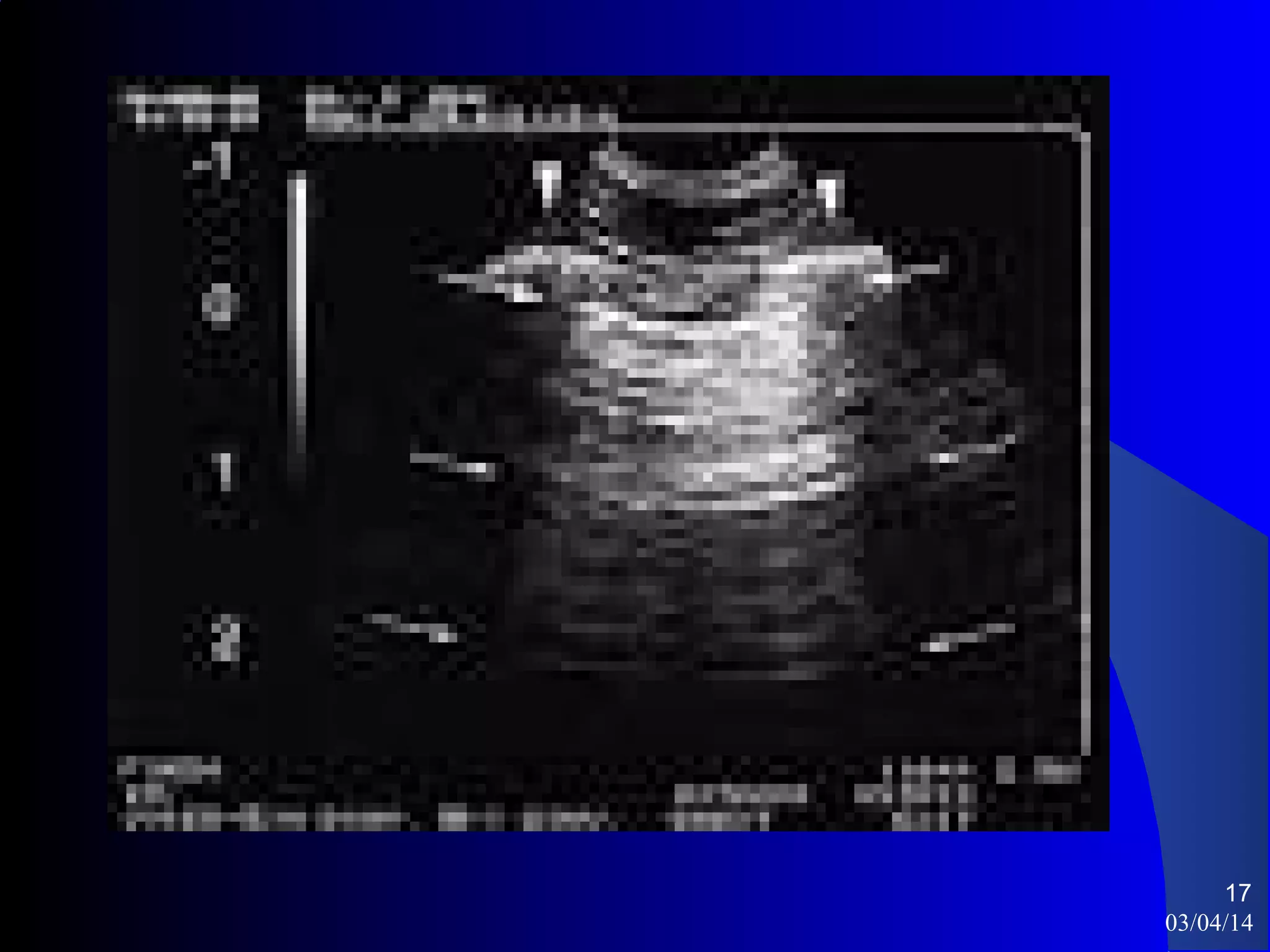 Chest ultrasound | PPT