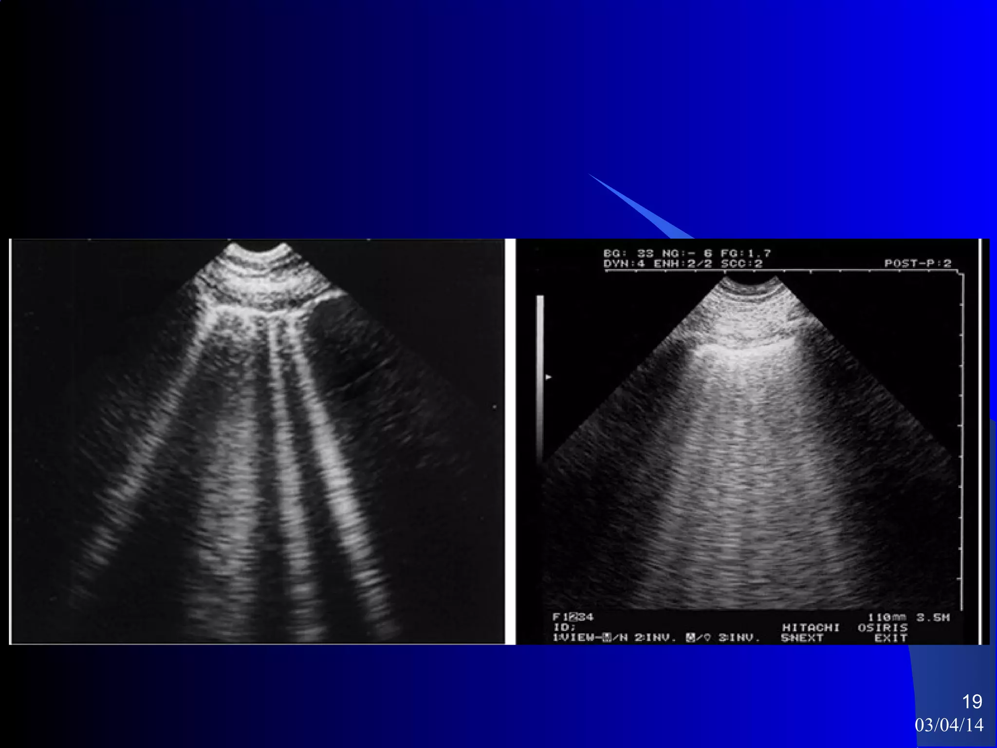 Chest ultrasound | PPT