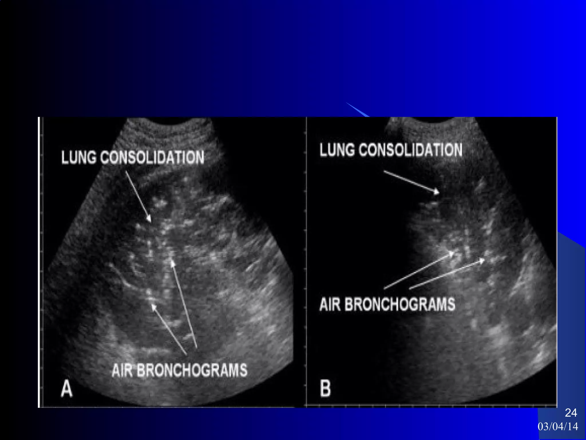 Chest ultrasound | PPT
